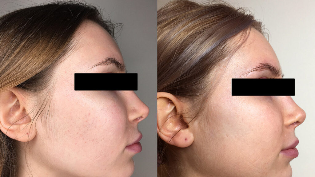 Kwas trójchlorooctowy (TCA) i jego synergistyczne współdziałanie z ...